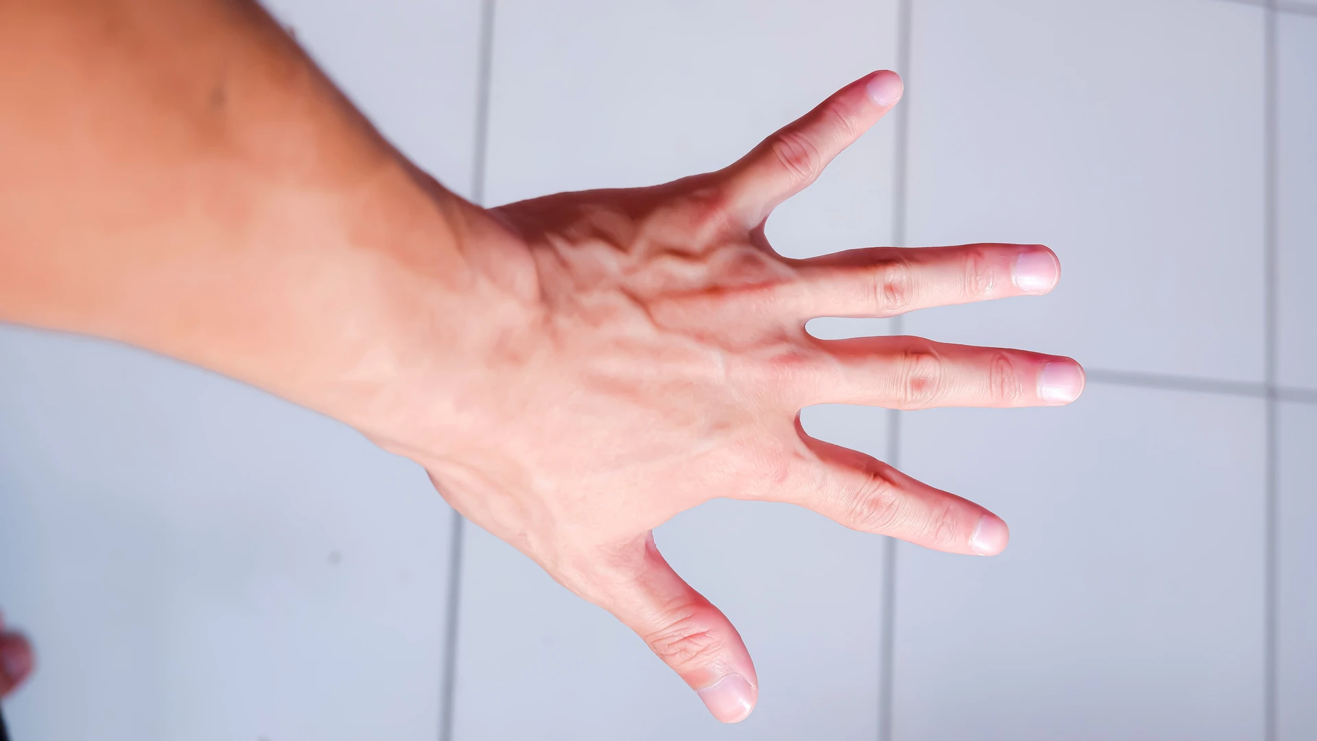 Hand Veins Macon, Locust Grove, Warner Robins, GA | #site_title Vein ...